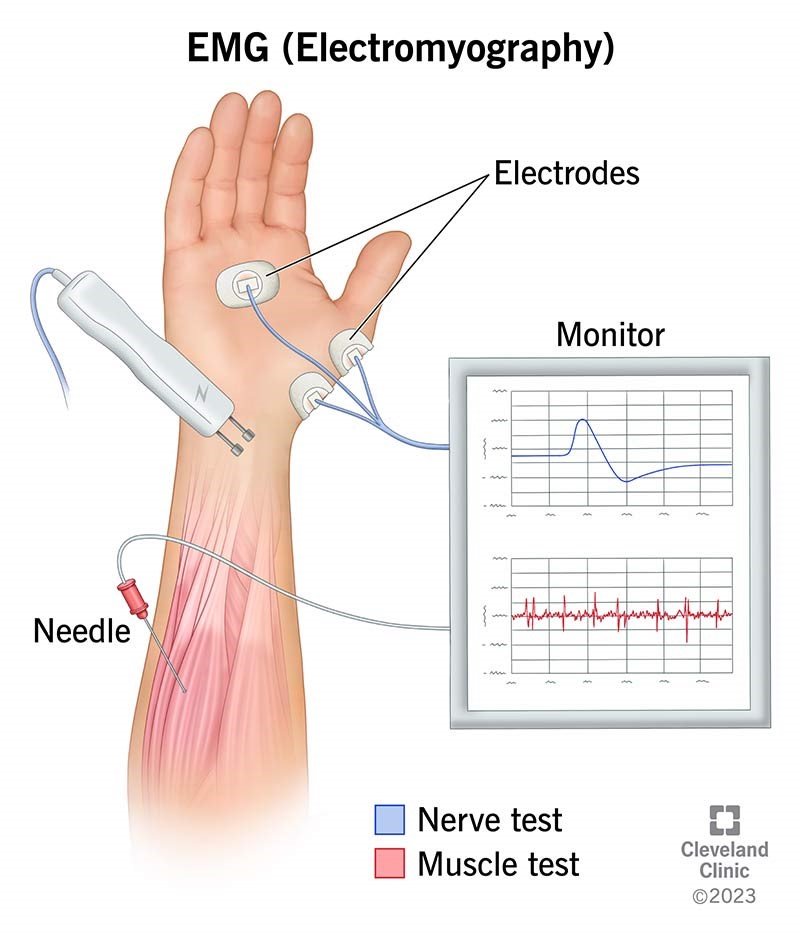 Electromyography (EMG) - swheal